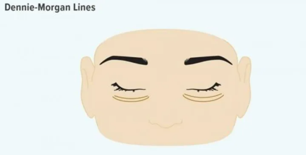 Líneas Dennie-Morgan, causas y tratamiento - Miwa Beauty Laser